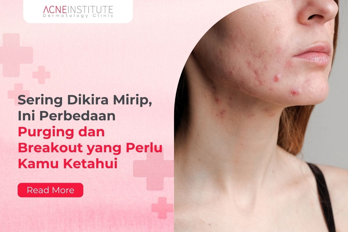 Sering Dikira Mirip, Ini Perbedaan Purging Dan Breakout Yang Perlu Kamu ...