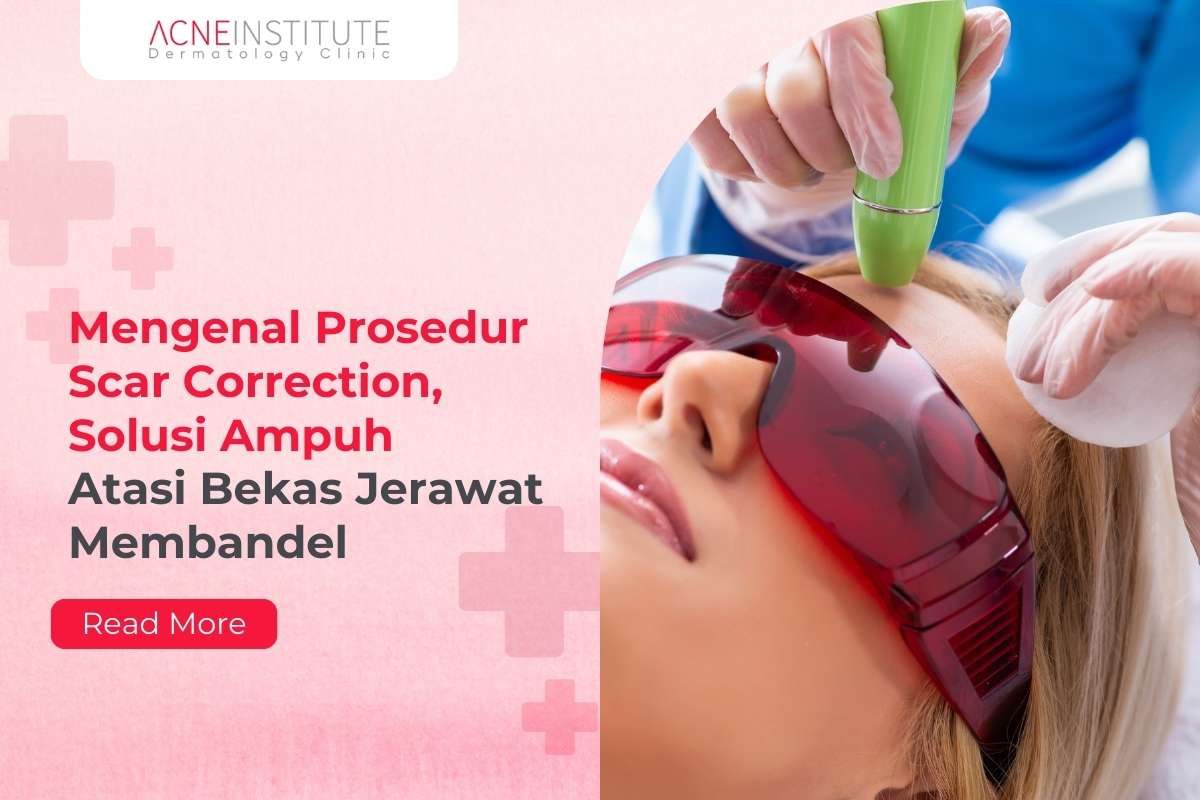 Mengenal Prosedur Scar Correction, Solusi Ampuh Atasi Bekas Jerawat ...