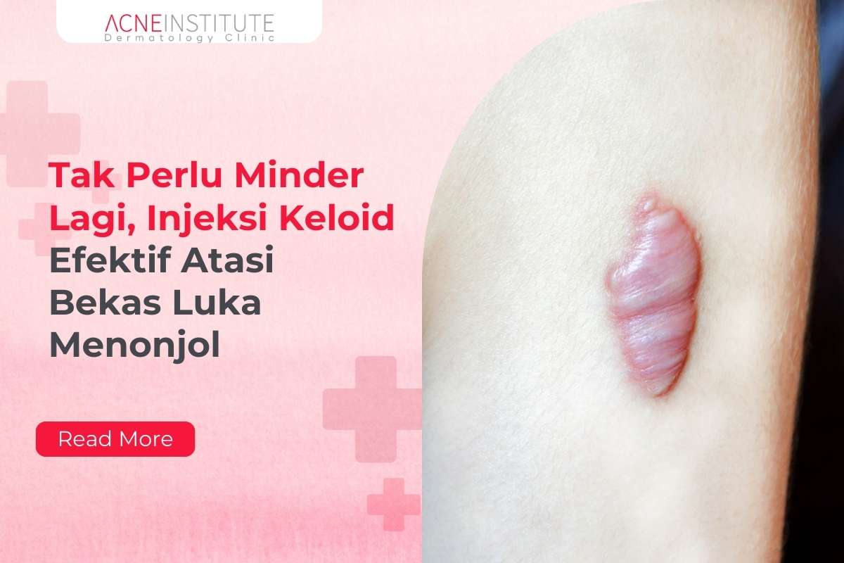 Tak Perlu Minder Lagi, Injeksi Keloid Efektif Atasi Bekas Luka Menonjol ...